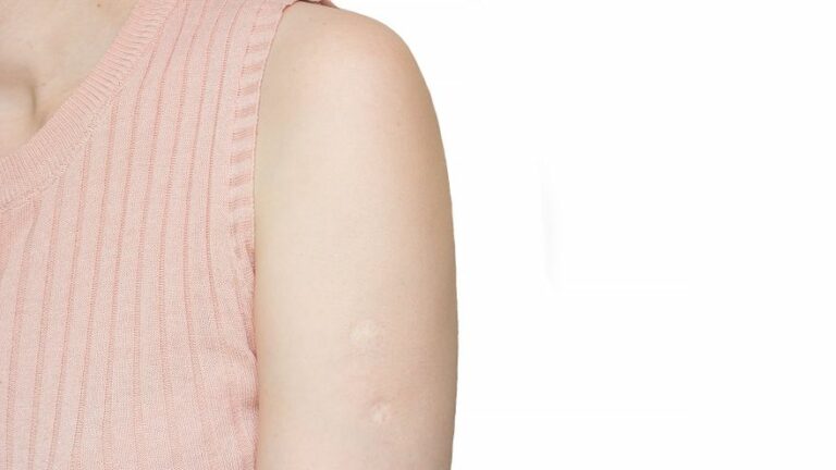 Is the vaccine mark on the arm from smallpox? - Royals Blue