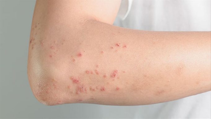 What is miliaria, the blisters and rashes that appear on our skin in ...